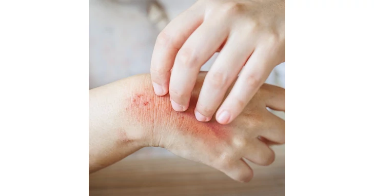 Mit árul el a bőröd? Kiütés típusok és hatékony kezelésük